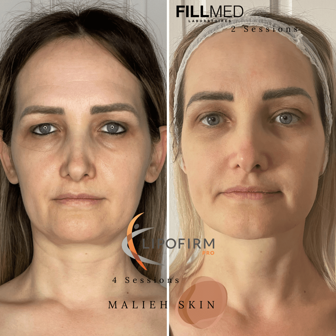 Lipofirm Pro - Malieh Skin