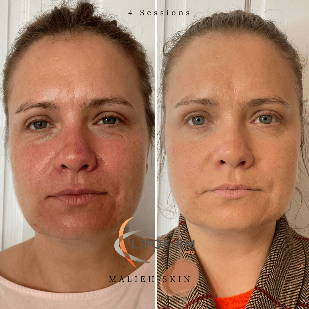 Lipofirm Pro - Malieh Skin