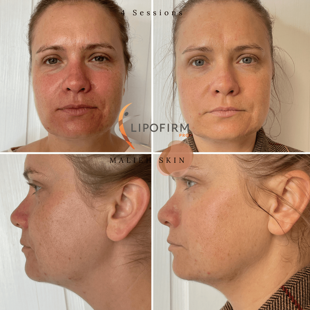 Lipofirm Pro - Malieh Skin