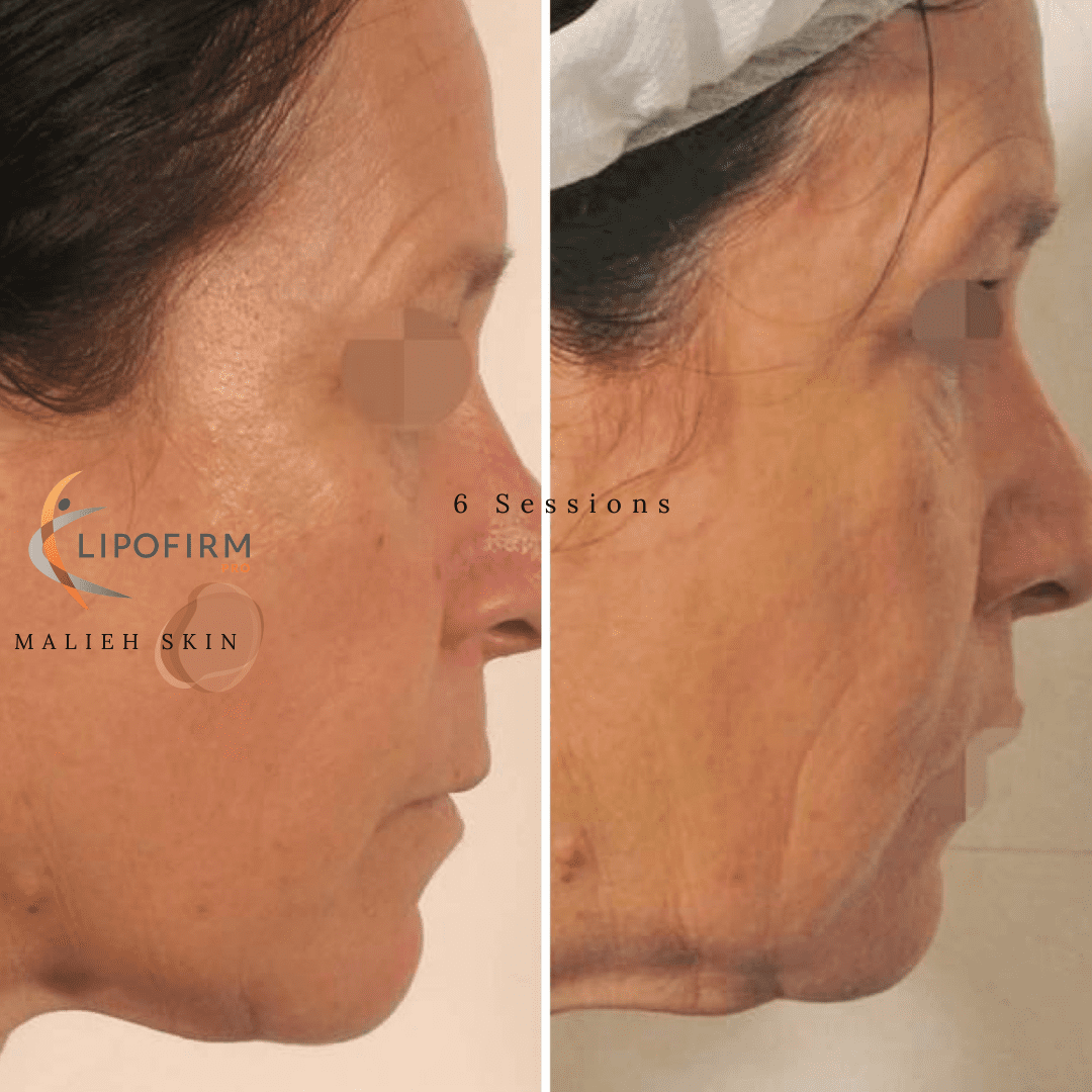 Lipofirm Pro - Malieh Skin
