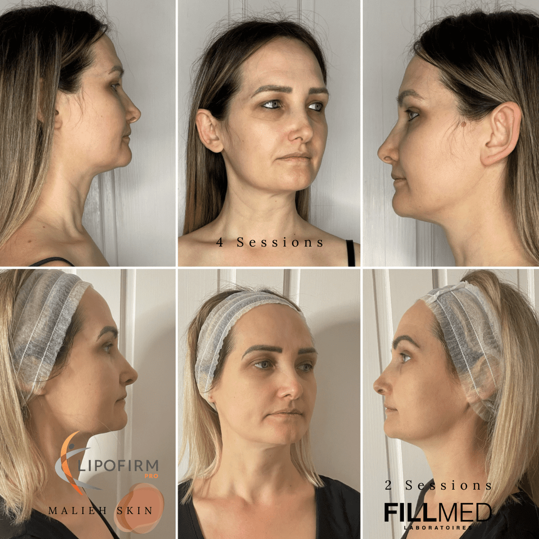 Lipofirm Pro - Malieh Skin