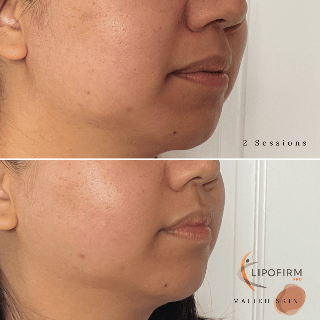 Lipofirm Pro - Malieh Skin