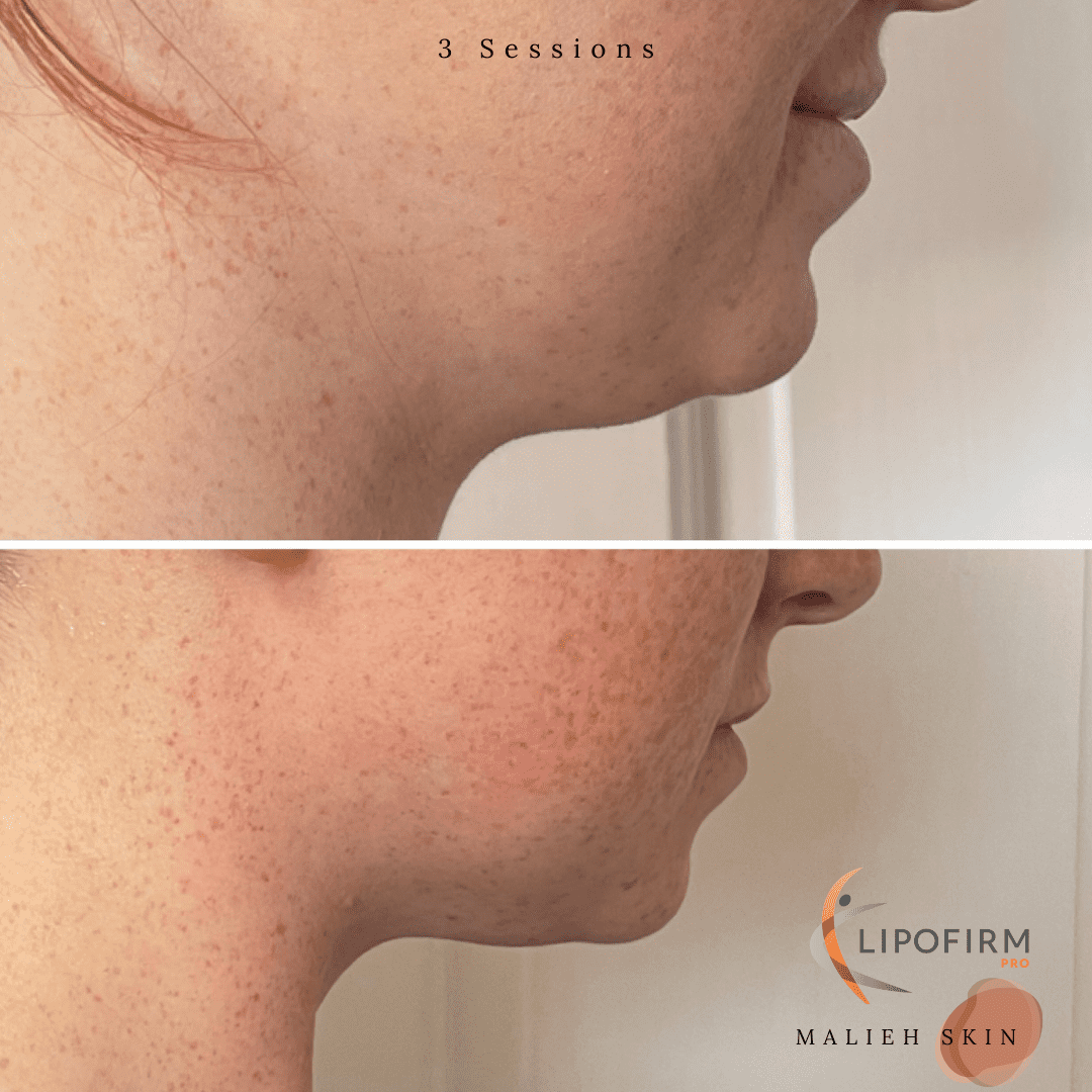 Lipofirm Pro - Malieh Skin