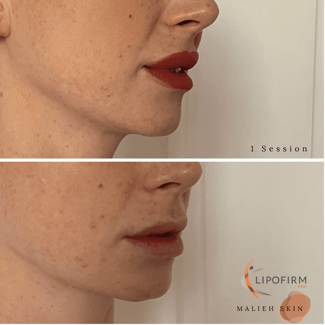 Lipofirm Pro - Malieh Skin