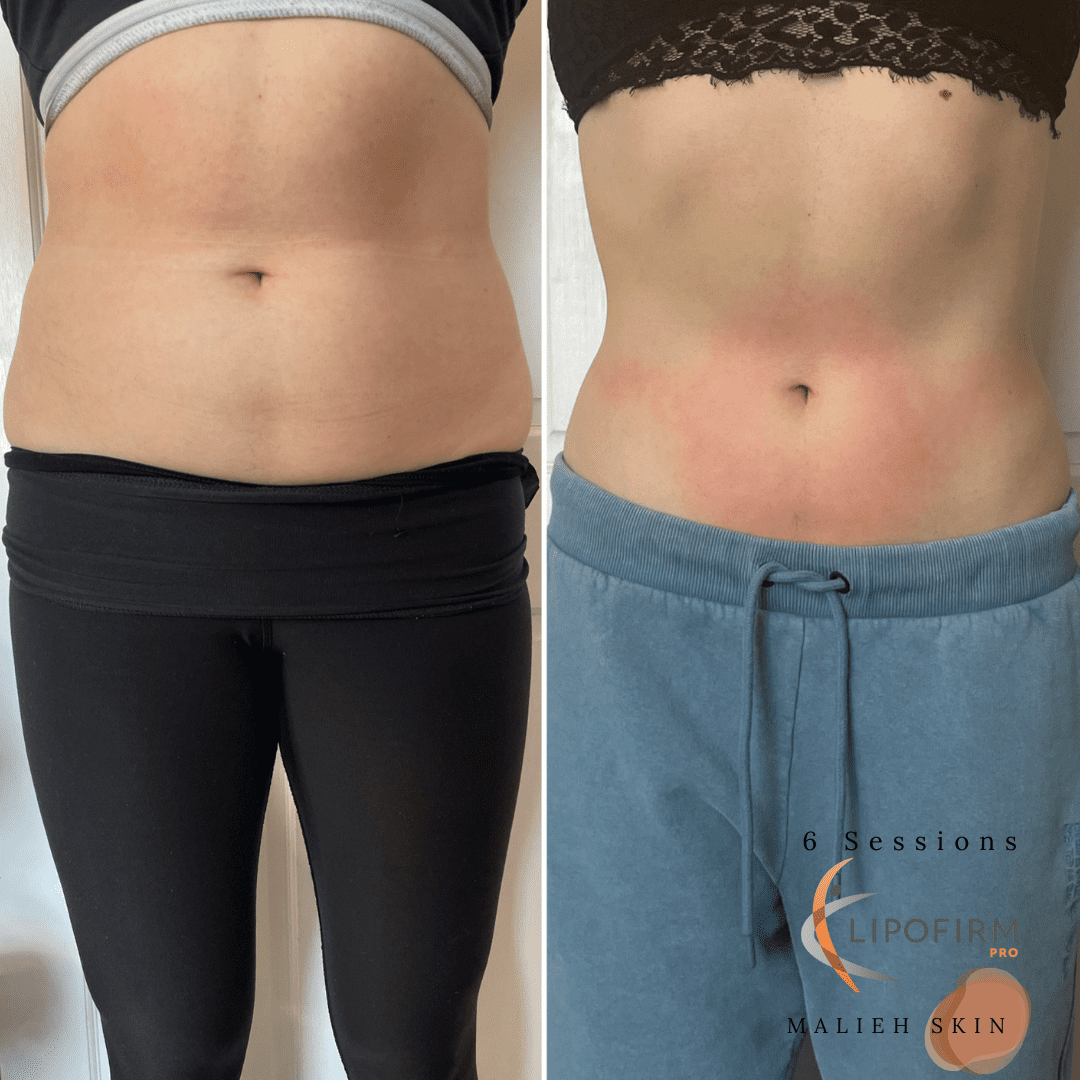 Lipofirm Pro - Malieh Skin