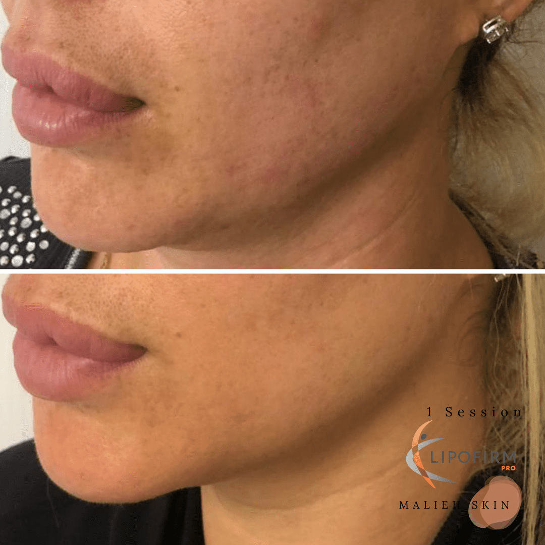 Lipofirm Pro - Malieh Skin